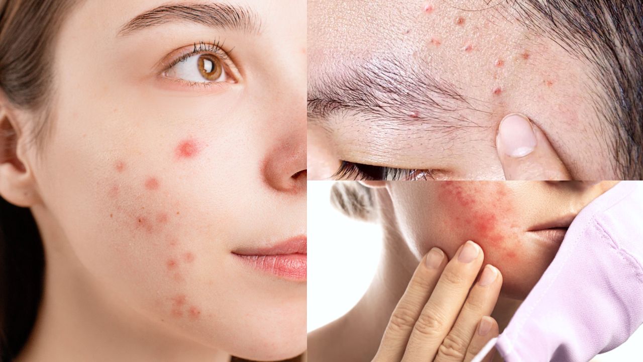 What is Acne Mechanica | DC Clinic